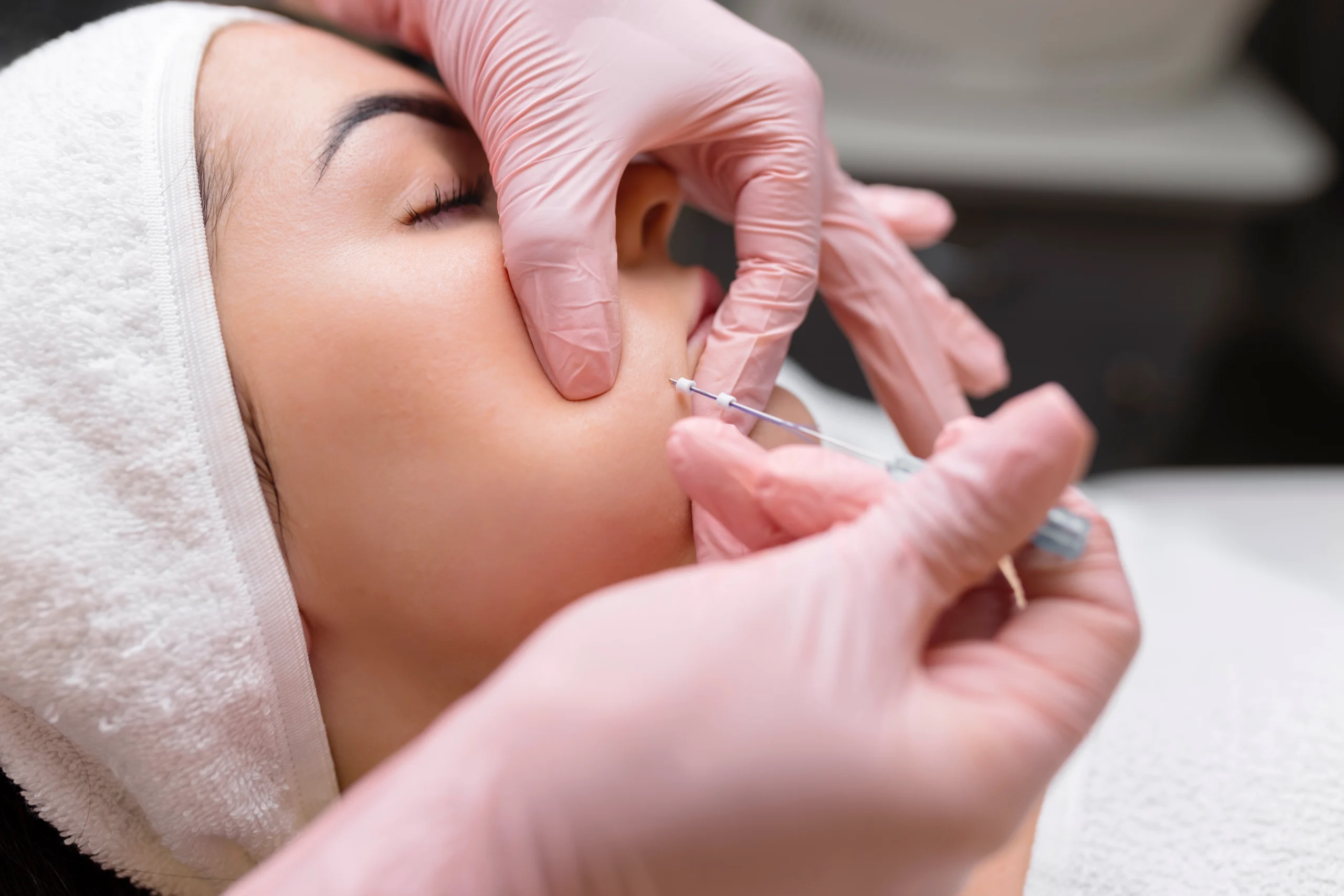 PDO Thread Lift - Mojo Aesthetics